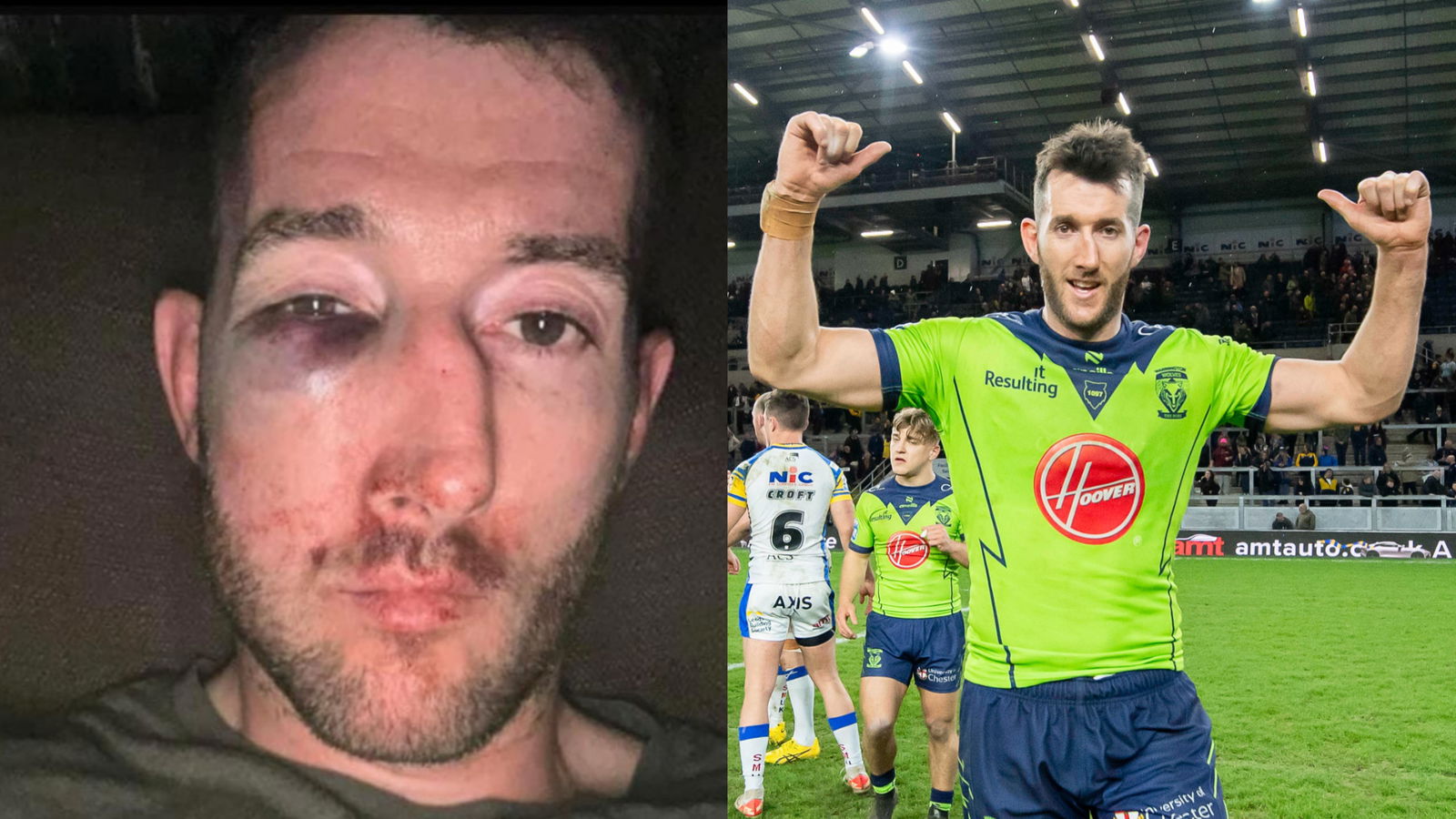 Warrington Wolves' Stefan Ratchford shows off brutal injury sustained ...